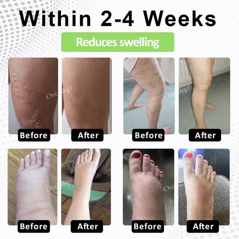 Oveallgo® CircuPro MAX Edema & Lymphatic Support Inhaler – Laracova