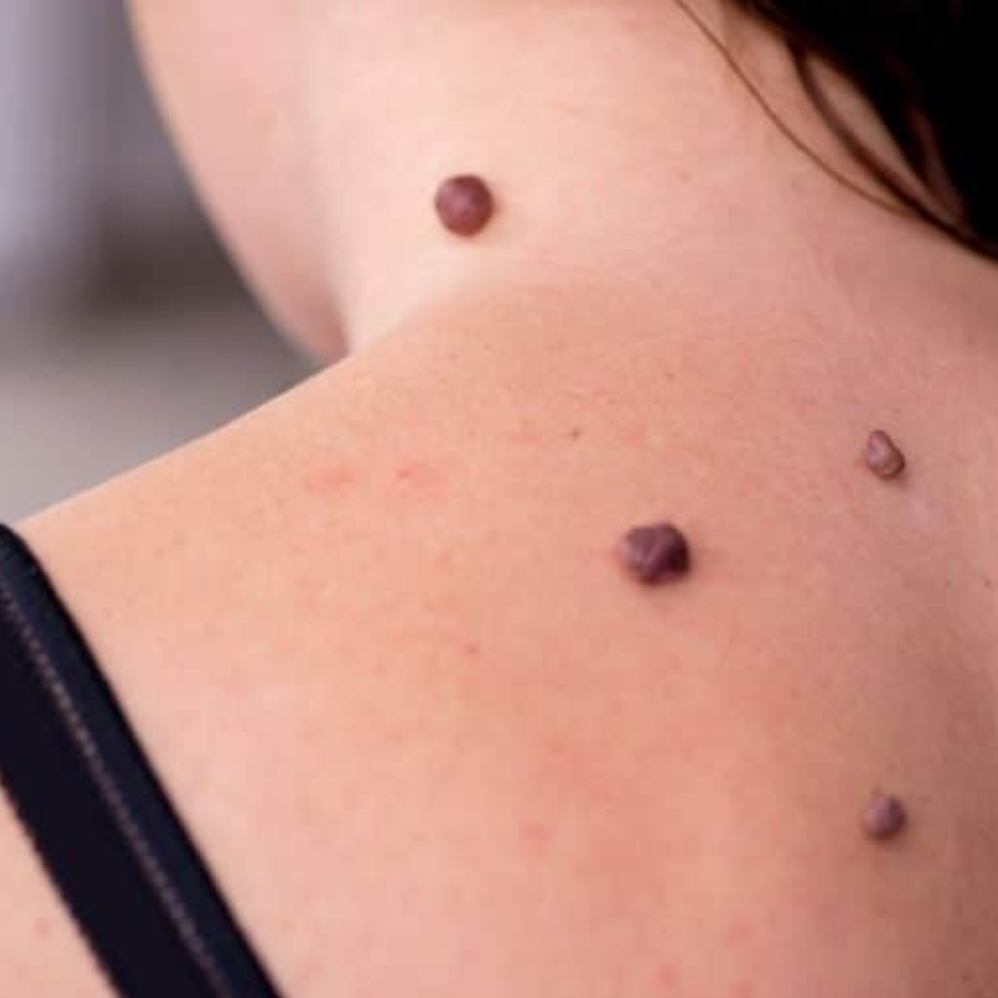 Bikenda® Non-Invasive Mole and Wart Removal Laser Pen – Laracova